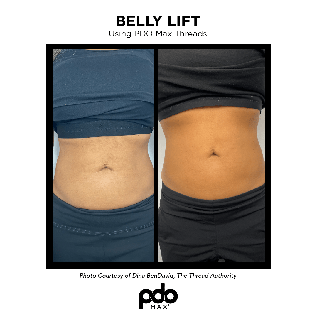 PDO Thread Lift - Glacier | Med Spa